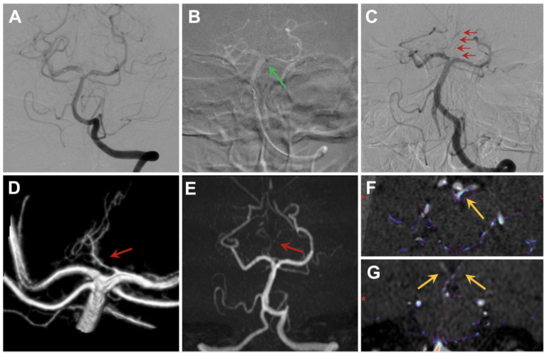 北見赤十字病院で勤務されている松島佑二郎先生がPercheron動脈を関与する脳底動脈閉塞症についてJNS Case Lessonsに発表され ...